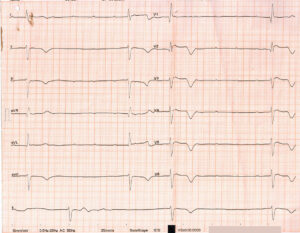 ECG Normal Range for R Wave in V5 and S Wave in V1