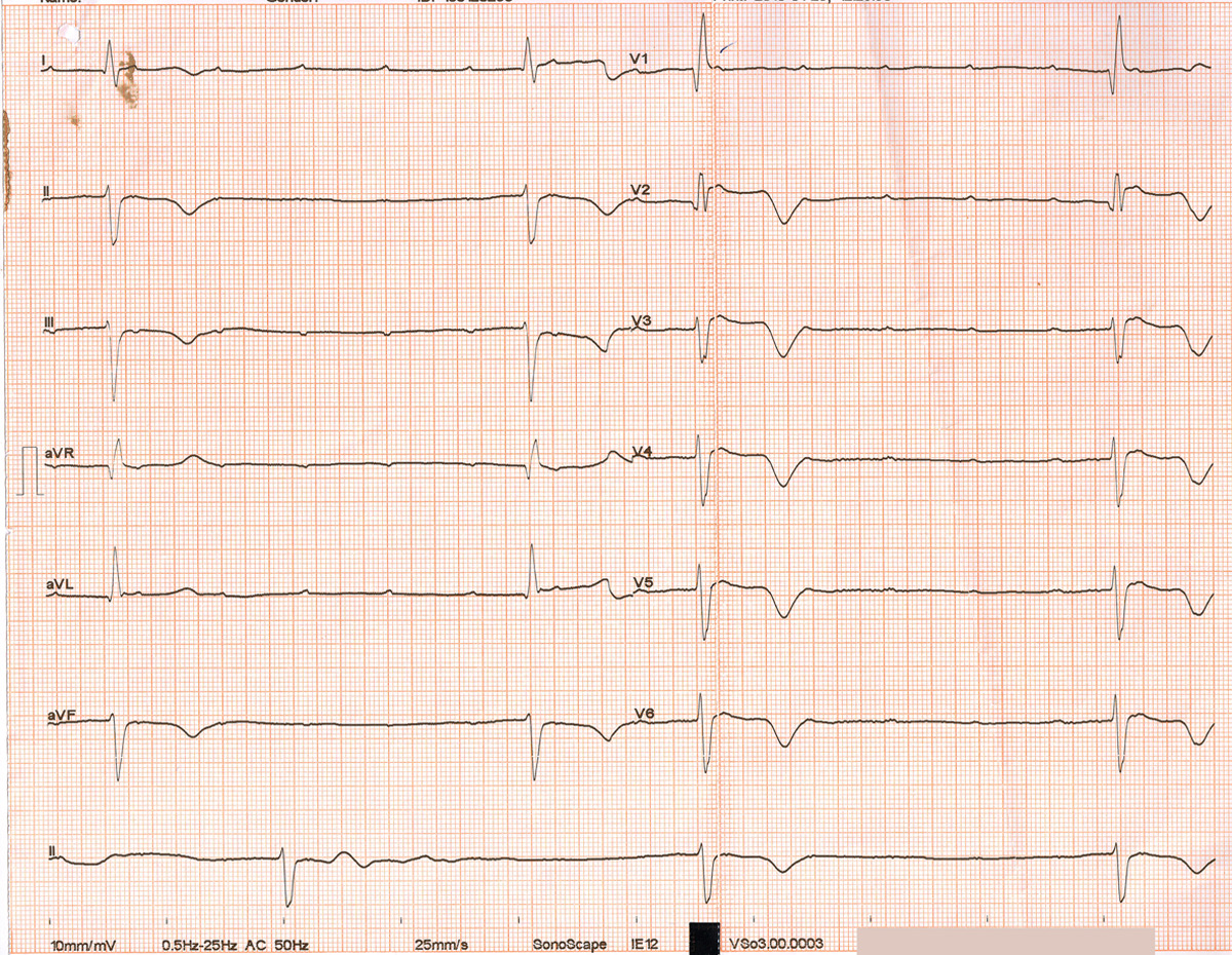 Understanding and Managing Complete Heart Block - Amit Shrivastava